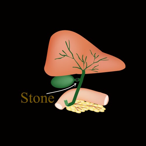 Gallbladder Stone Vector Images (over 140)
