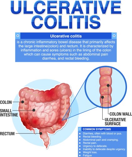 Ulcerative colitis symptoms infographic Royalty Free Vector