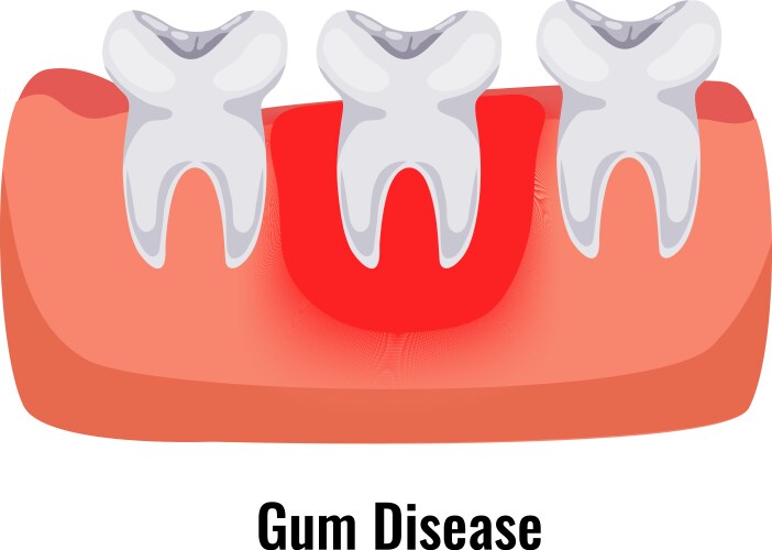 Gingivitis gum disease and sad teeth cartoon Vector Image