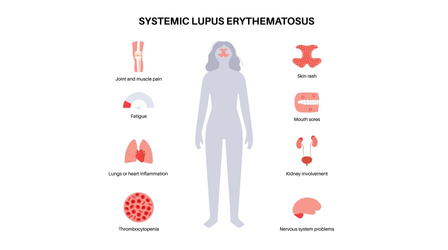 Systemic lupus erythematosus Royalty Free Vector Image