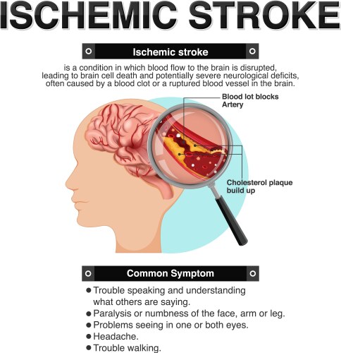 Informative poster of common types stoke Vector Image