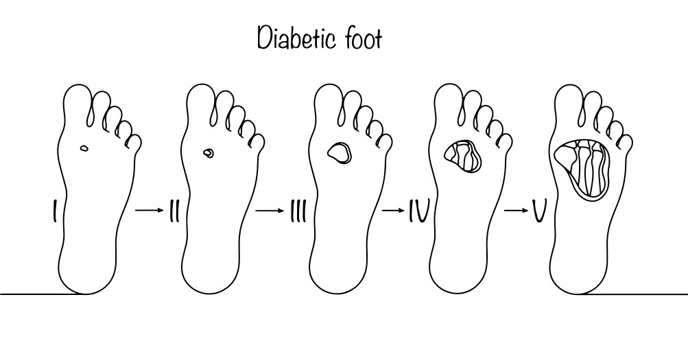 Diabetic Foot Vector Images (over 630)