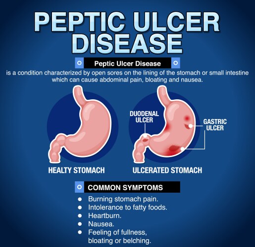 Peptic ulcer disease infographic Royalty Free Vector Image