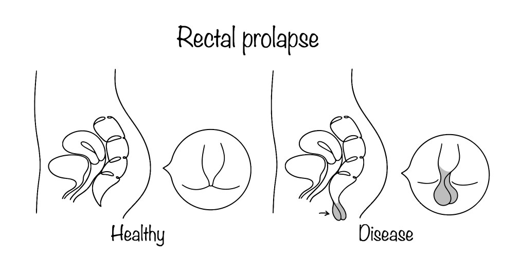 Uterine prolapse Royalty Free Vector Image - VectorStock