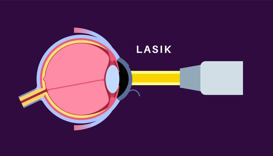 Lasik eye surgery Royalty Free Vector Image - VectorStock