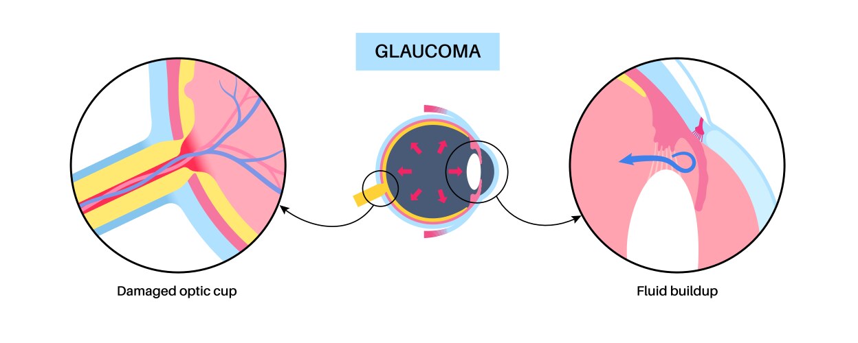Glaucoma eye disease Royalty Free Vector Image