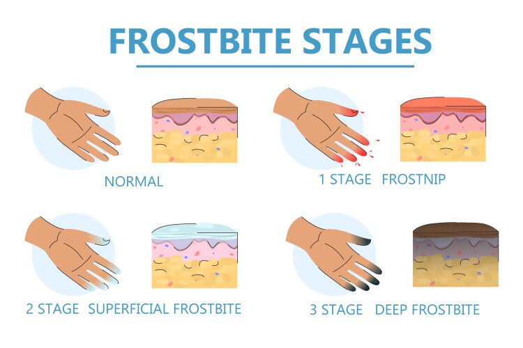 Hypothermia Vector Images (over 470)