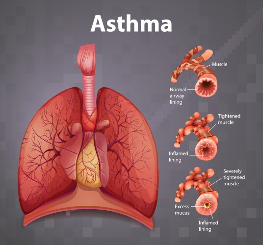 Human Lung Anatomy - Asthma Diagram – Royalty-Free Vector | VectorStock