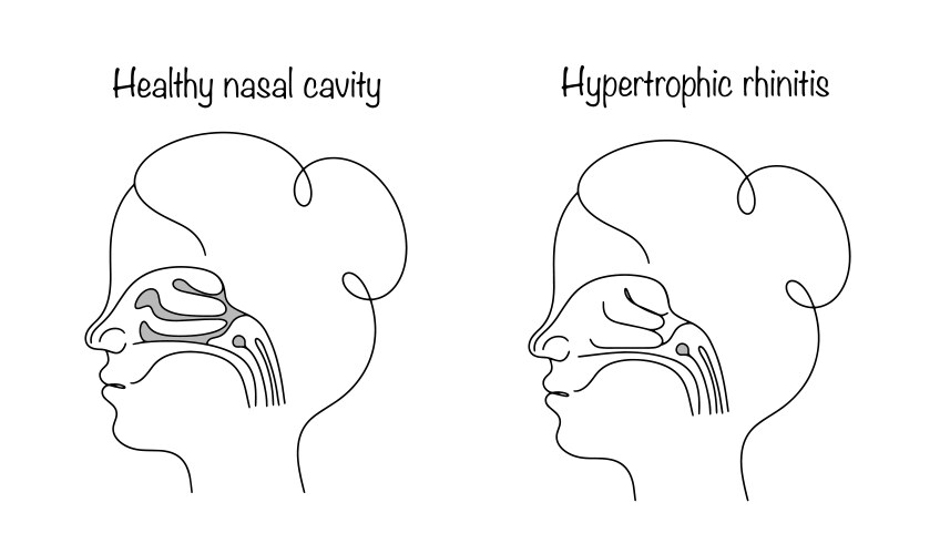 Vertebral wedging Royalty Free Vector Image - VectorStock