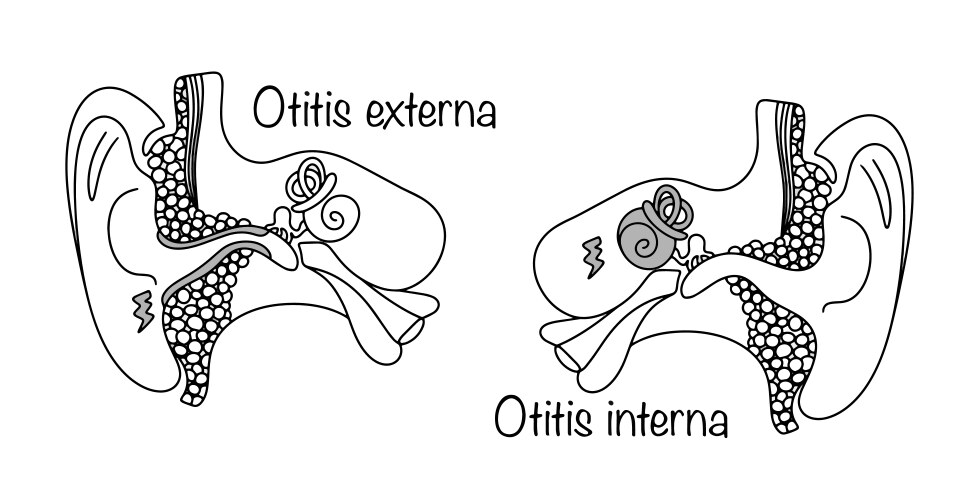 Otitis Interna Suppurative Otitis Media ENT Info