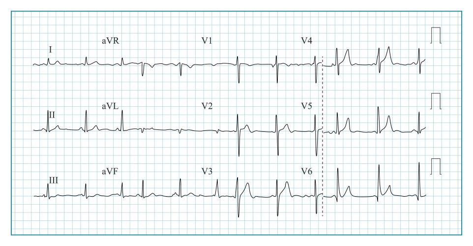 Heart Rhythm Cardiogram Charts Royalty Free Vector Image