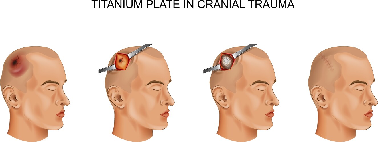 Traumatic Brain Injury Vector Images (over 130)