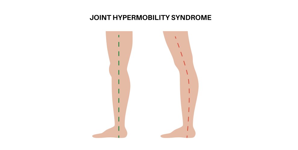 Joint hypermobility poster Royalty Free Vector Image