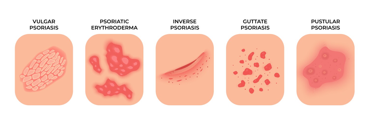 Allergic Reaction Vector Images (over 3,700)