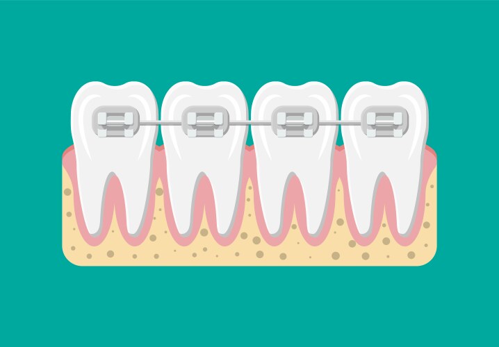 Braces Cartoon Vector Images (over 1,900)