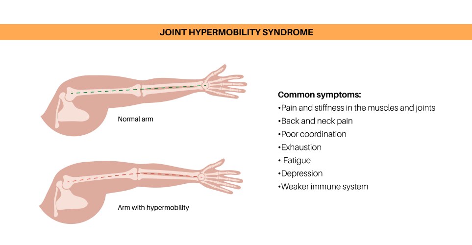 Joint hypermobility poster Royalty Free Vector Image