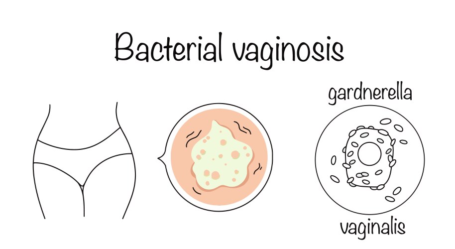 Vaginal Discharge Vector Images (74)