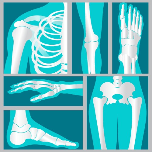 Bone and skeletal diseases set with medical names Vector Image