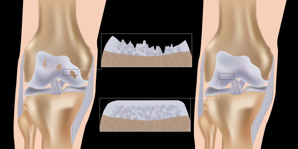 Osteoarthritis Vector Images (over 3,300)