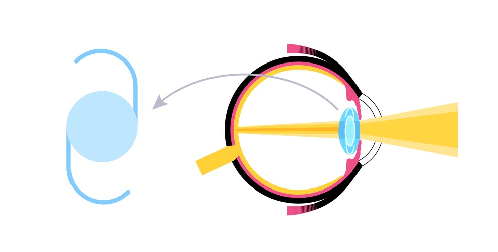 Intraocular lens poster Royalty Free Vector Image