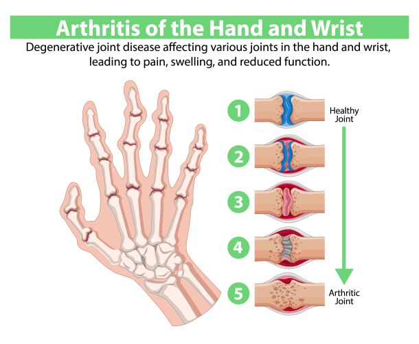 Degenerative joint disease affecting hand Vector Image