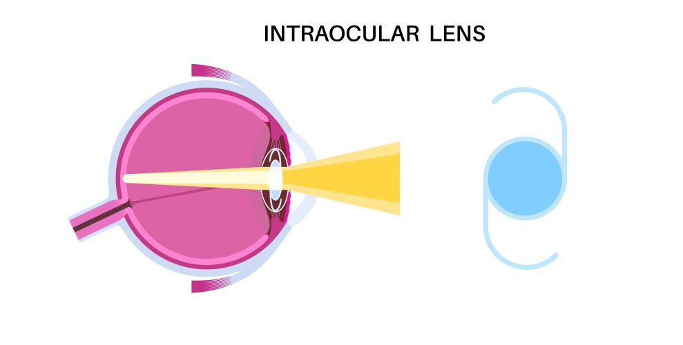 Intraocular lens poster Royalty Free Vector Image