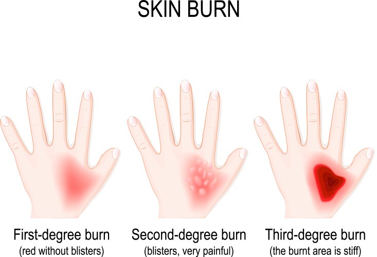Burns Skin Degree Vector Images (over 110)