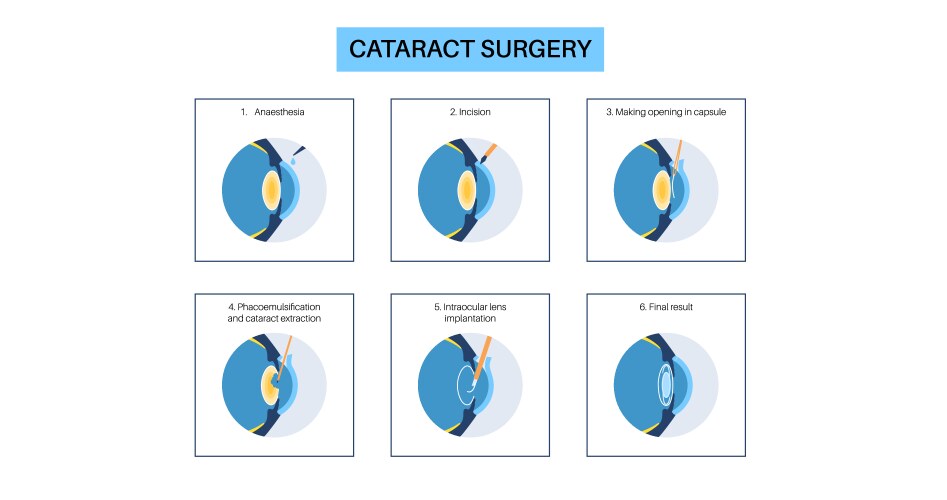 Cataract surgery poster Royalty Free Vector Image