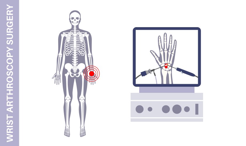 Wrist arthroscopy surgery Royalty Free Vector Image