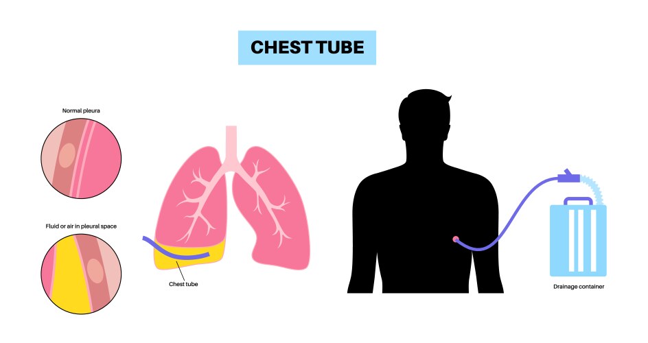 Chest Tube Vector Images (over 620)