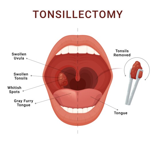 Tonsillectomy Vector Images (56)