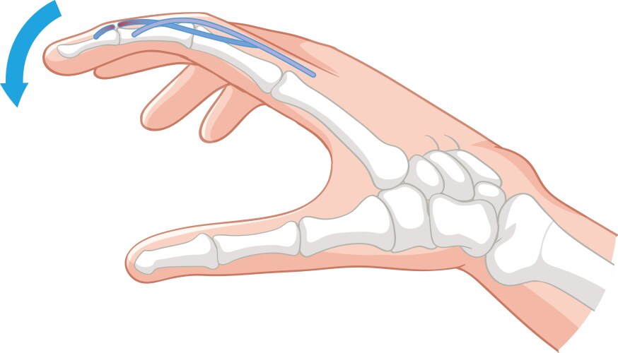 Depicts rupture of extensor digitorum tendon Vector Image
