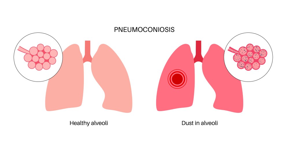 Pneumoconiosis lung disease Royalty Free Vector Image