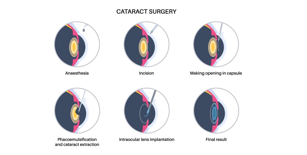 Cataract surgery poster Royalty Free Vector Image