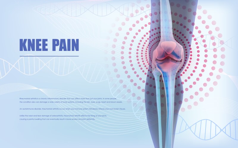 Osteoarthritis knee poster Royalty Free Vector Image