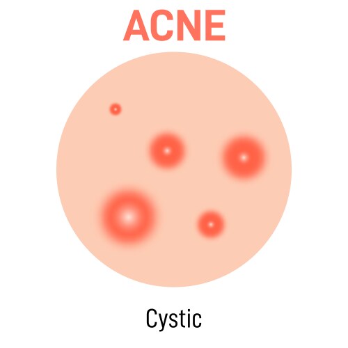 Cyst skin acne type icon disease Royalty Free Vector Image