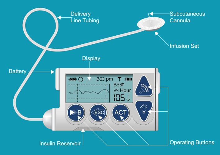 Insulin pump therapy Royalty Free Vector Image