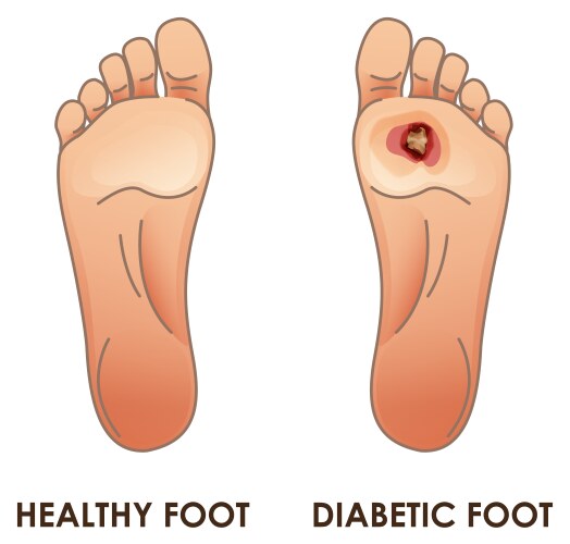 Diabetic Foot Vector Images (over 630)