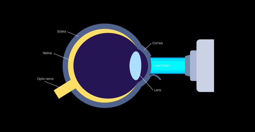 Lasik eye surgery Royalty Free Vector Image - VectorStock