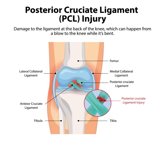 Acl Vector Images (over 140)