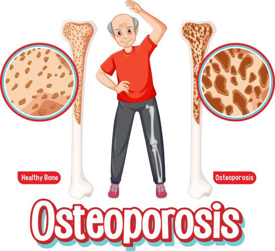 Comparison of normal bone Royalty Free Vector Image