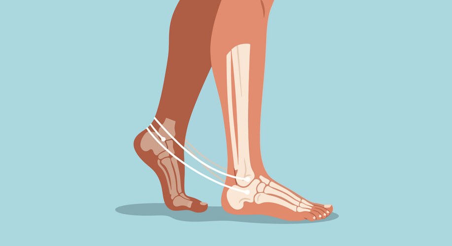 Ankle Sprain: Ligament Tear Diagram – Royalty-Free Vector | VectorStock