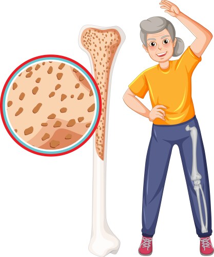Causes osteoporosis and bone loss Royalty Free Vector Image