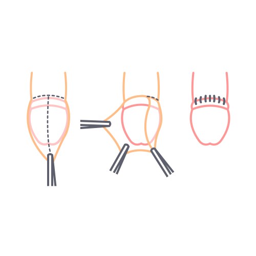 Foreskin Vector Images (75)