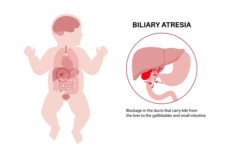 Biliary atresia disease Royalty Free Vector Image