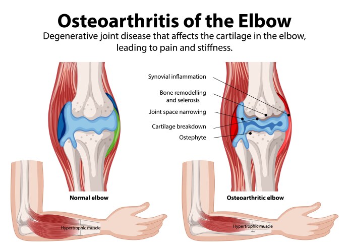 Comparison of normal and dislocated elbow joints Vector Image
