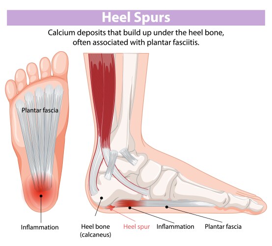 Detailed diagram of foot inflammation Royalty Free Vector