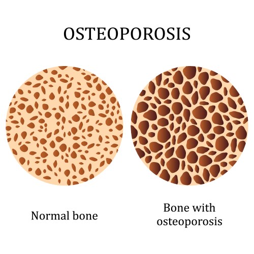 Osteoporosis Vector Images Over 9 100