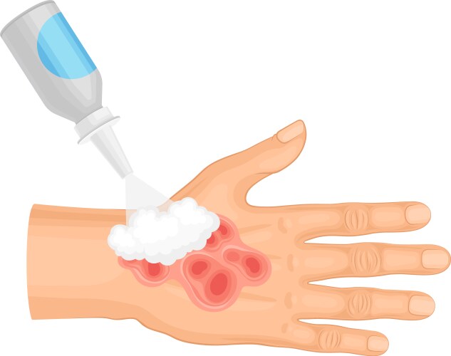 First aid for hand with ambustion or burn Vector Image