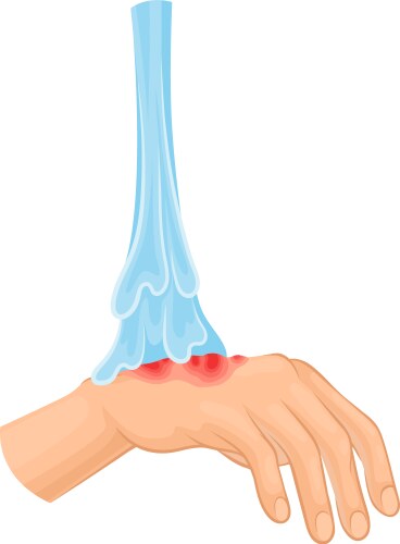 First aid for hand with ambustion or burn Vector Image